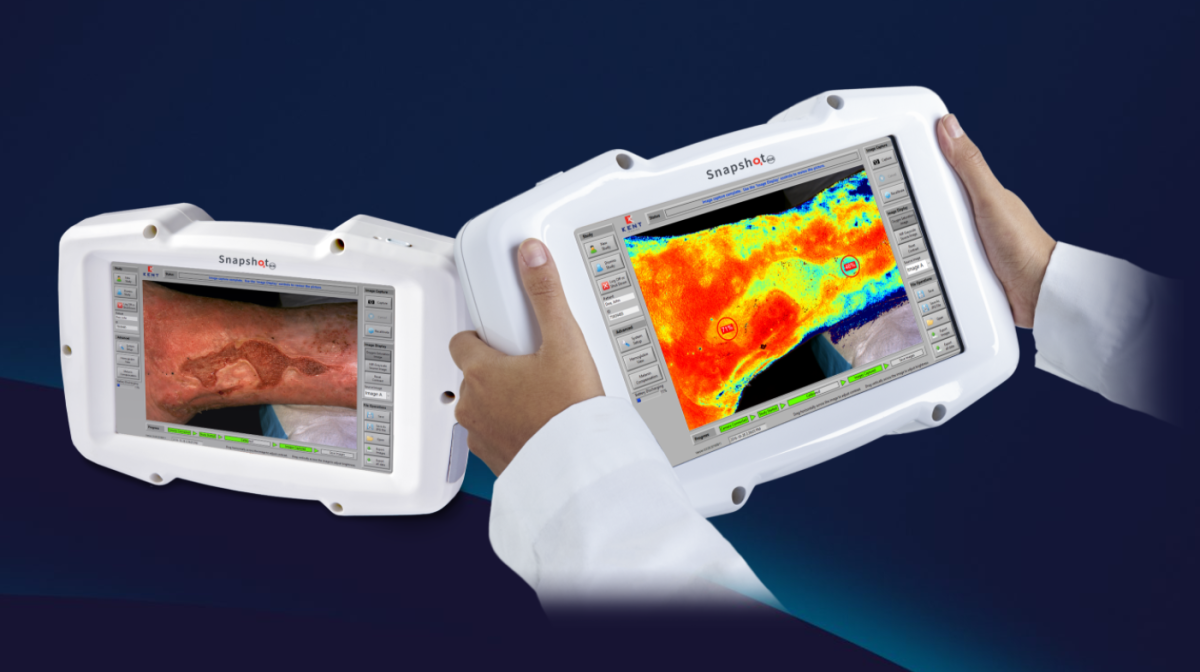 Advanced wound care imaging with just a click of a camera - Alberta ...
